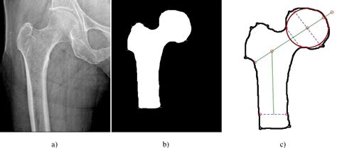 Figure 4 From Optimizing Osteoporosis Classification Through Femur Bone