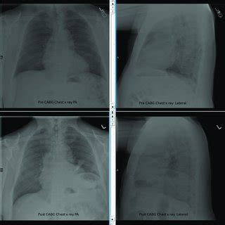 Chest X Ray Pre And Post Cardiac Bypass Surgery Cabg Showing Elevated