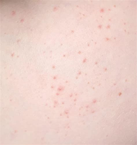 Red Spots On Stomach I Have Gastritis Its Not Really Itch But It Is