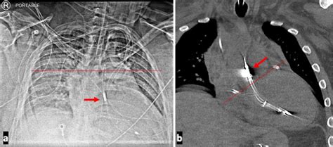 Role Of Computed Tomography And Chest Radiography In Imaging Of Impella