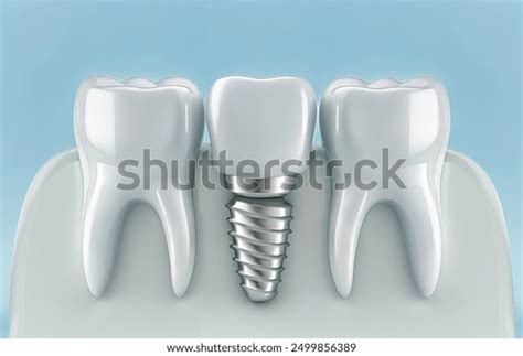 Dental Implants Human Teeth Placement Within Stock Illustration 2499856389 Shutterstock