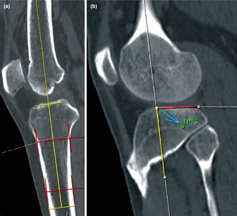 A Proximal Tibial Longitudinal Axis In True Sagittal Plane Yellow Download Scientific