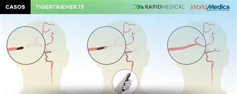 Case Report Tigertriever 13 Case Performed With Our Thrombus