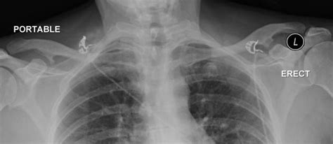 Coracoclavicular Joint Pacs