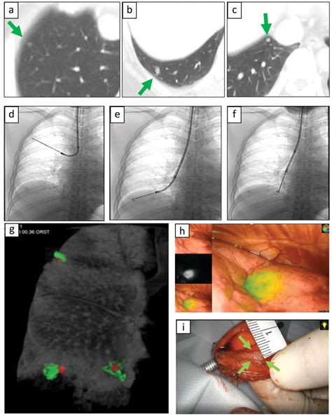 An Example Of The Procedure In A Patient With Three Multiple Pulmonary Download Scientific