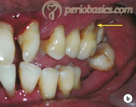 Furcation Involvement And Its Management
