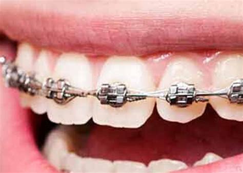 Conventional Braces Primecare Dental Clinic Shah Alam