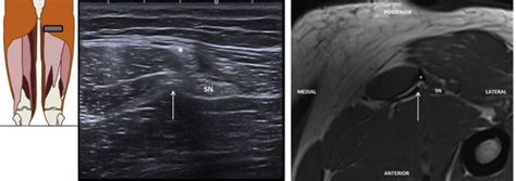 Ultrasound Assessment Of The Hamstrings Complex Of Athletes With Mri