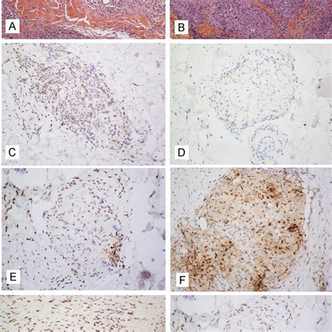 Lymph Node Biopsies Left Column Cvid Right Column Sarcoidosis A