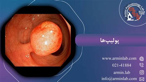 پولیپ ها آزمایشگاه آرمین بیماری های تنفسی آزمایش خون