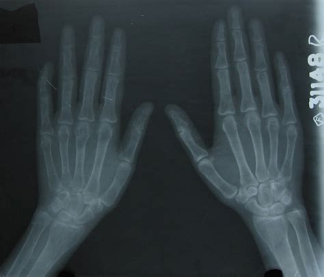 Primary Hyperthyroidism As Giantcell Tumor Dr Vasu
