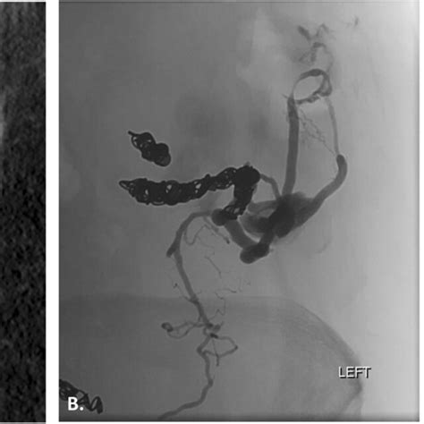 Periostomal Varices Embolization With Nbca A 57 Year Old With