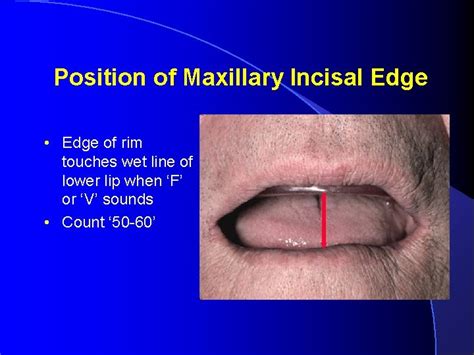 Maxillomandibular Relationships Occlusal Vertical Dimension Transverse