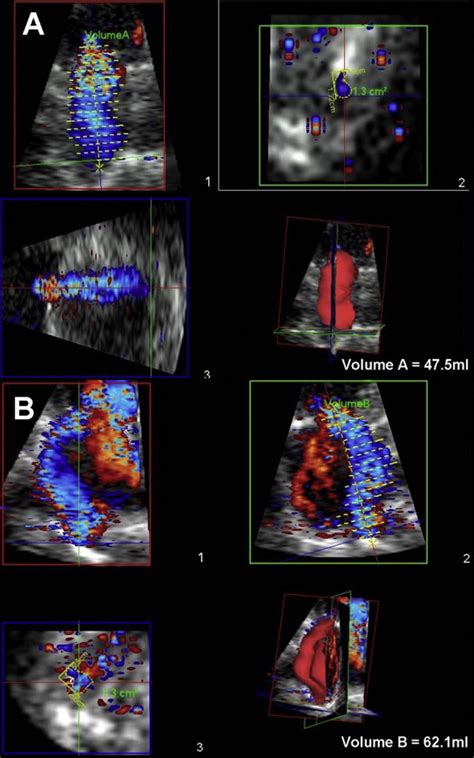 Quantification Of Mitral Regurgitation By General Imaging Three
