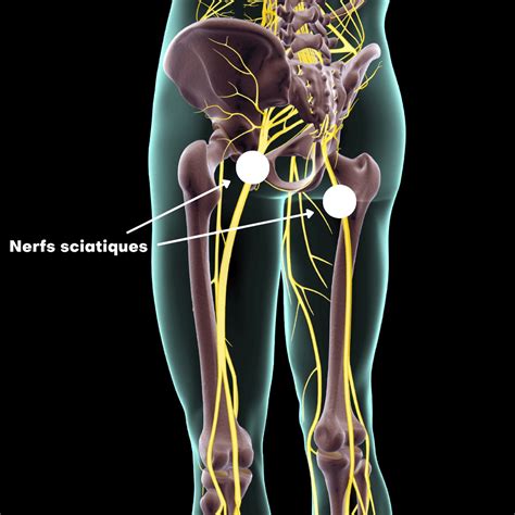 Les Douleurs Sciatiques Clinique Iaso