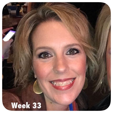 My Fashionable Designs Adult Braces I Got Braces Again