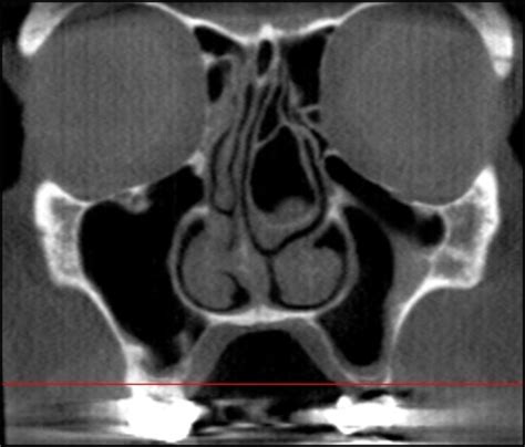 Sinus Anatomic Variants That Predispose Post Implant Morbidity