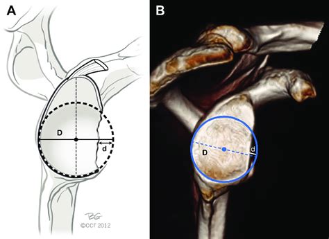 A Illustration And B Enface View Of The Glenoid Fossa On