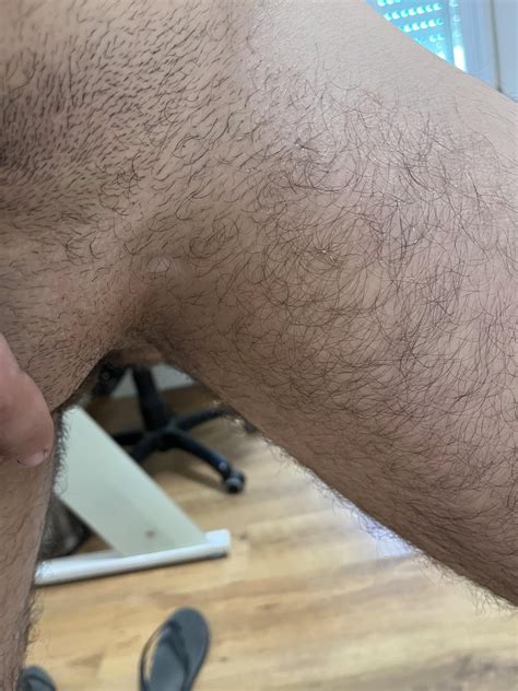 Intertrigo Rdermatologyquestions