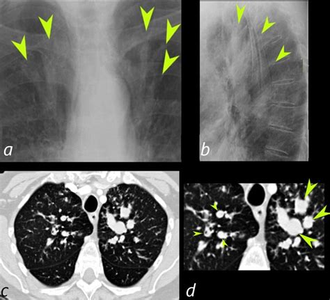227lu Allergic Bronchopulmonary Aspergillosis Finger In Glove Lungs