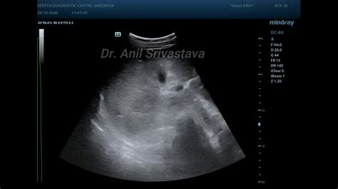 Pyemic Liver Abscess Youtube