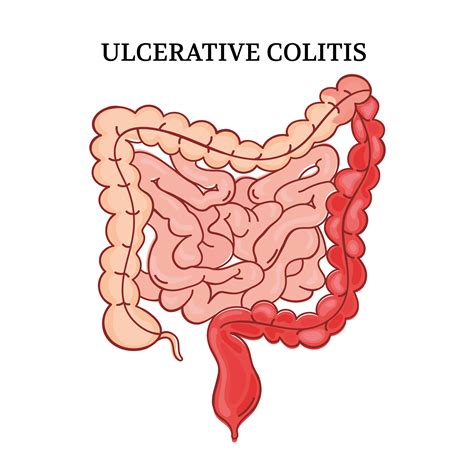 Ulcerative Colitis Causes Symptoms And Treatment Hyperthermia