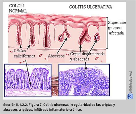 Geteccu Endi Ii121 Endoscopia En El Diagnóstico De La Colitis Ulcerosa