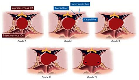 Aggressive Pituitary Tumors Neuroendocrinology Karger Publishers