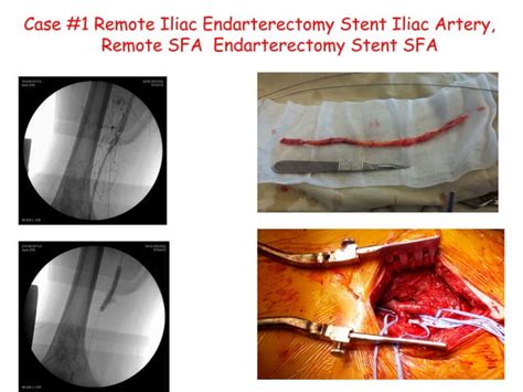 Hybrid Procedure Pdf Heart And Cardiovascular Diseases Diseases
