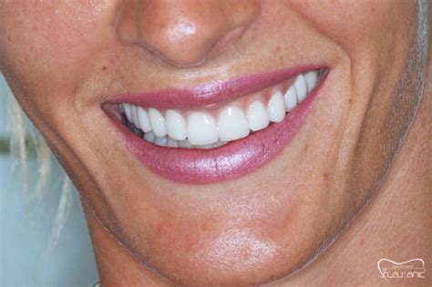 Zubne Krunice Zagreb Poliklinika Šlaj Anić Stomatologija