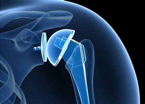 Shoulder Replacement Surgery Shoulder Surgeon Austin Round Rock