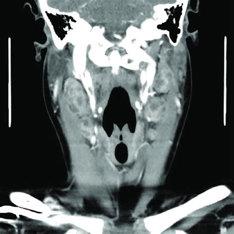 Clinical Photograph Showing A Necrotic Lesion On The Right Palatine