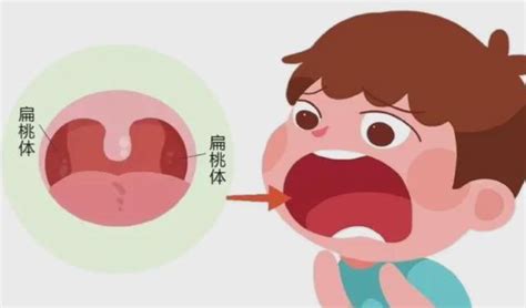 扁桃体发炎了，怎么治疗才有效？ 家庭保健报