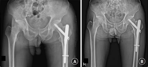 Avulsion Fractures Of The Hip Bone