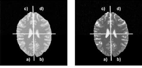 Figure 1 From Markov Random Field Segmentation Of Brain Mr Images Semantic Scholar
