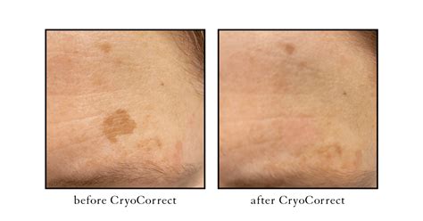 Sunspot On Skin Treatment