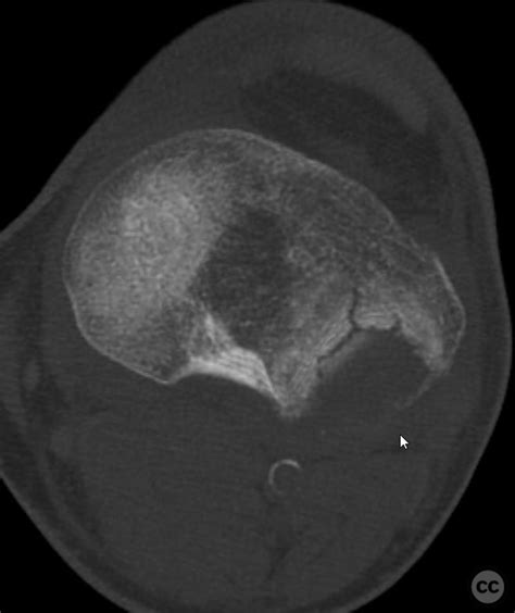 Two Window Posterolateral Approach To Frosch Zone Pllplc