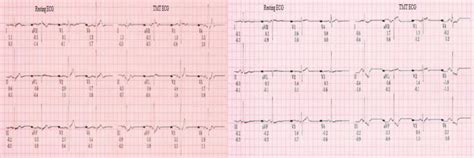 The Scanned Paper Ecg Of 12 Lead Signals For Normal Left And