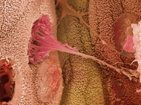 Standardized Definition Of Mild To Moderate Ulcerative Colitis Needed