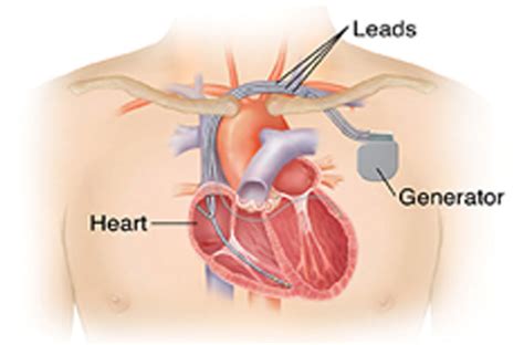 Biventricular Pacemaker