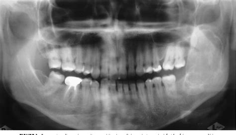 Hemimandibulectomy Semantic Scholar
