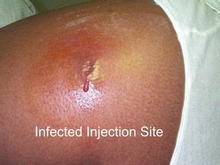 Cannula And Infection Pps