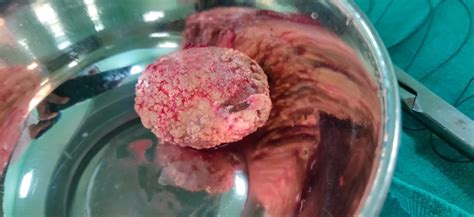 Bladder Calculus Rmedizzy