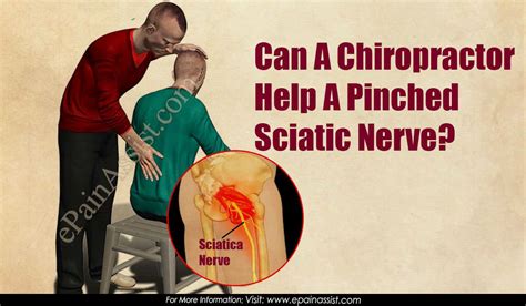 Can A Chiropractor Help A Pinched Sciatic Nerve