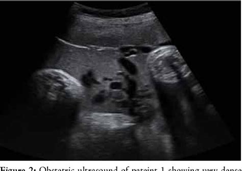 Figure 2 From Review Of Very Echogenic Amniotic Fluid At Term And Its
