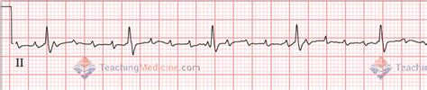 Atrial Flutter Ecg Strip