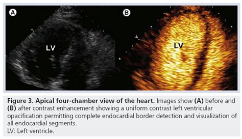 Perflutren Lipid Microsphere Injectable Suspension For Cardiac Ul