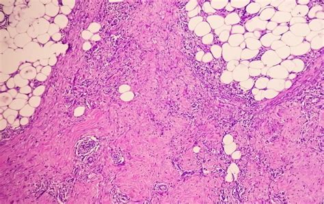 Premium Photo Photomicrograph Of Granulomatous Tissue Histology