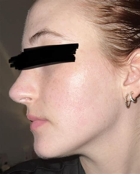 4 Months Post Accutane After An 8 Month Cycle Raccutane