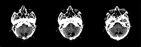 Post Operative Head Ct Scan Showing The Outcomes Of A Suboccipital Download Scientific Diagram